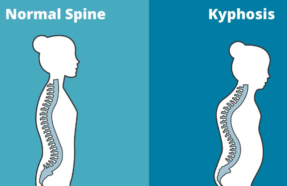 Kyphosis Solutions | ProActive Physiotherapy West Kelowna, BC